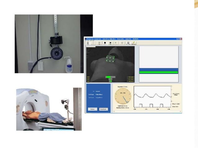 Breast Cancer Radiation Therapy: RT Plan evaluation & Recent Advances ...