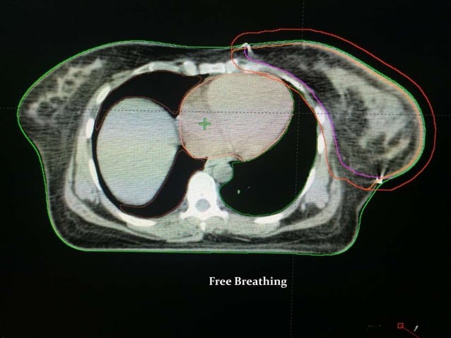 Breast Cancer Radiation Therapy: RT Plan evaluation & Recent Advances ...