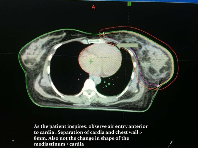 Breast Cancer Radiation Therapy: RT Plan evaluation & Recent Advances ...