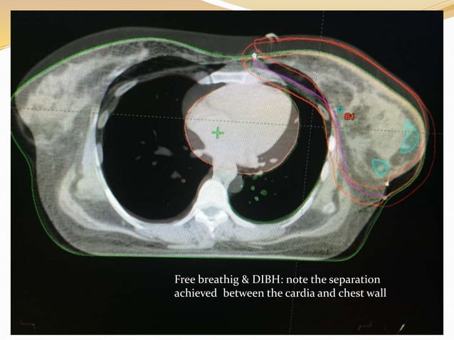 Breast Cancer Radiation Therapy: RT Plan evaluation & Recent Advances ...
