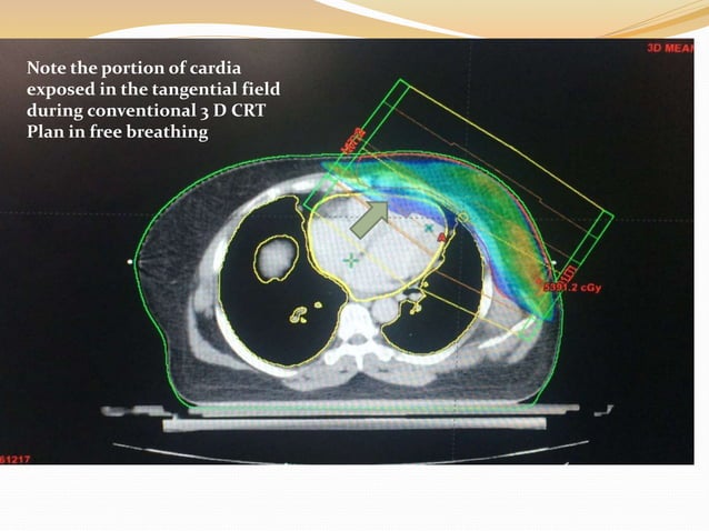 Breast Cancer Radiation Therapy: RT Plan evaluation & Recent Advances ...