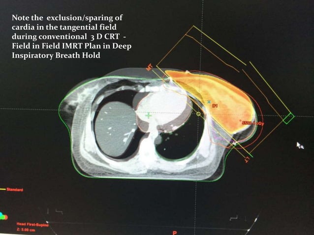 Breast Cancer Radiation Therapy: RT Plan evaluation & Recent Advances ...