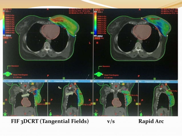 Breast Cancer Radiation Therapy: RT Plan evaluation & Recent Advances ...