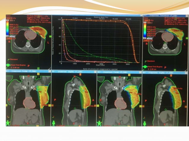 Breast Cancer Radiation Therapy: RT Plan evaluation & Recent Advances ...
