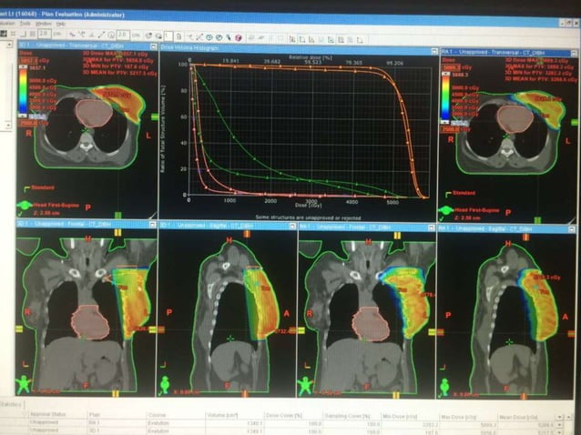 Breast Cancer Radiation Therapy: RT Plan evaluation & Recent Advances ...