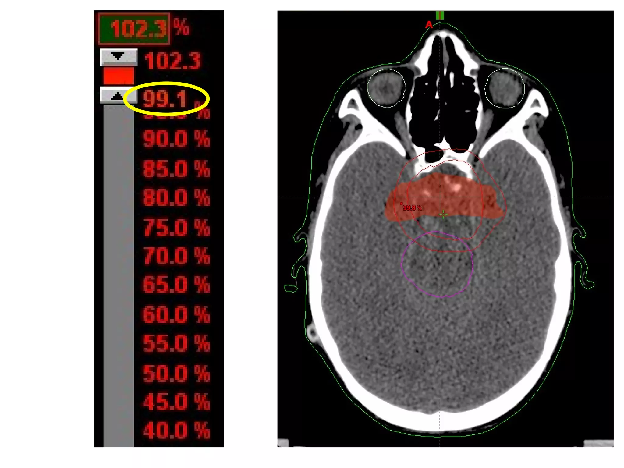 Radiotherapy plan evaluation in brain tumours | PPT