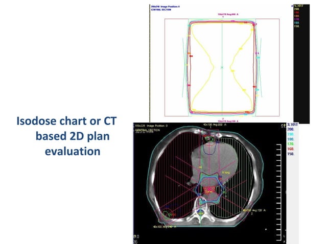 Radiotherapy plan evaluation in brain tumours | PPT | Brain and Nervous ...