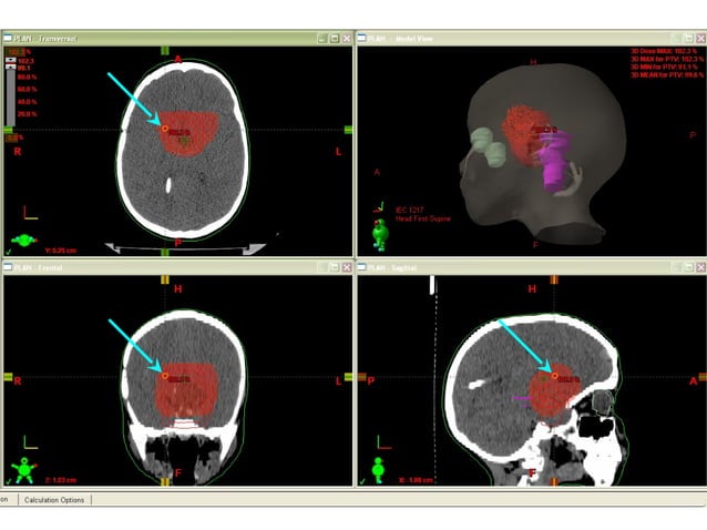 Radiotherapy plan evaluation in brain tumours | PPT | Brain and Nervous ...