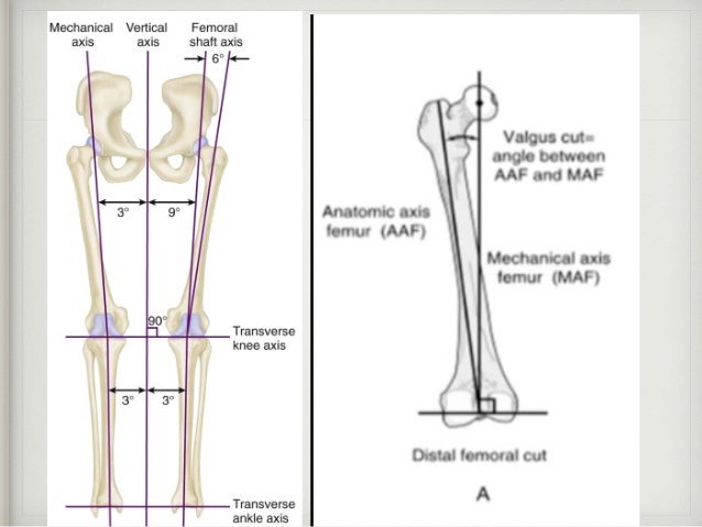 Planning knee replacement on xrays