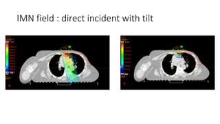 Planning Meet : Chest wall & IMN | PPTX