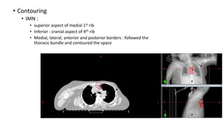 Planning Meet : Chest wall & IMN | PPT