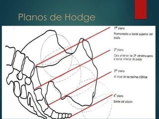 Planos de Hodge GINECOLOGIA Y OBSTETRICIA.pptx