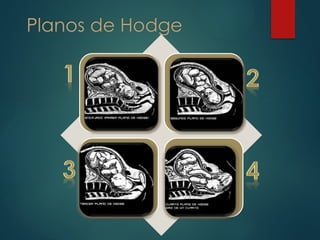 Planos de Hodge GINECOLOGIA Y OBSTETRICIA.pptx