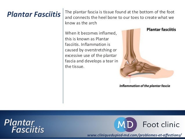 Plantar Fasciitis : Origin, Causes, Examination, Treatment of plantar…