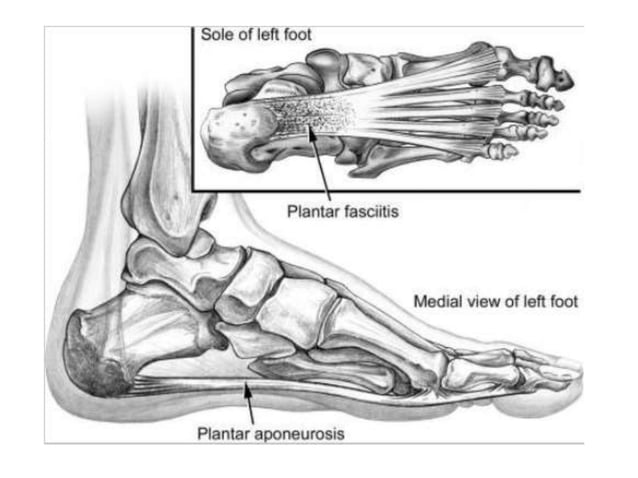 Plantar fasciitis.pptx