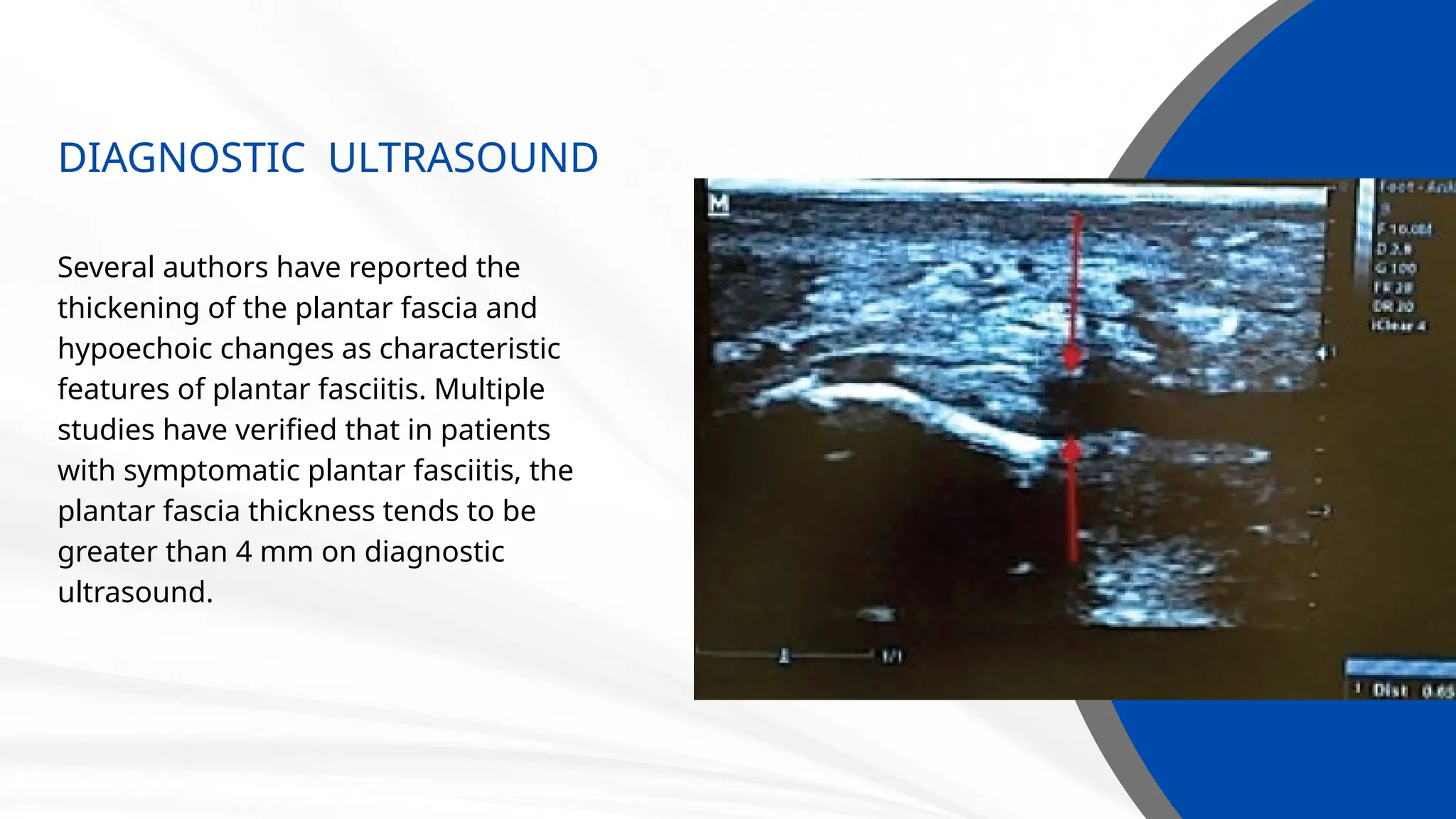 PLANTAR FASCIITIS or PLANTER HEEL PAIN.pptx