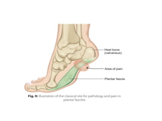 plantar fascitis.pptx management and clinical features | PPTX