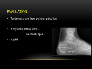 Plantar fascitis, fibrositis | PPTX