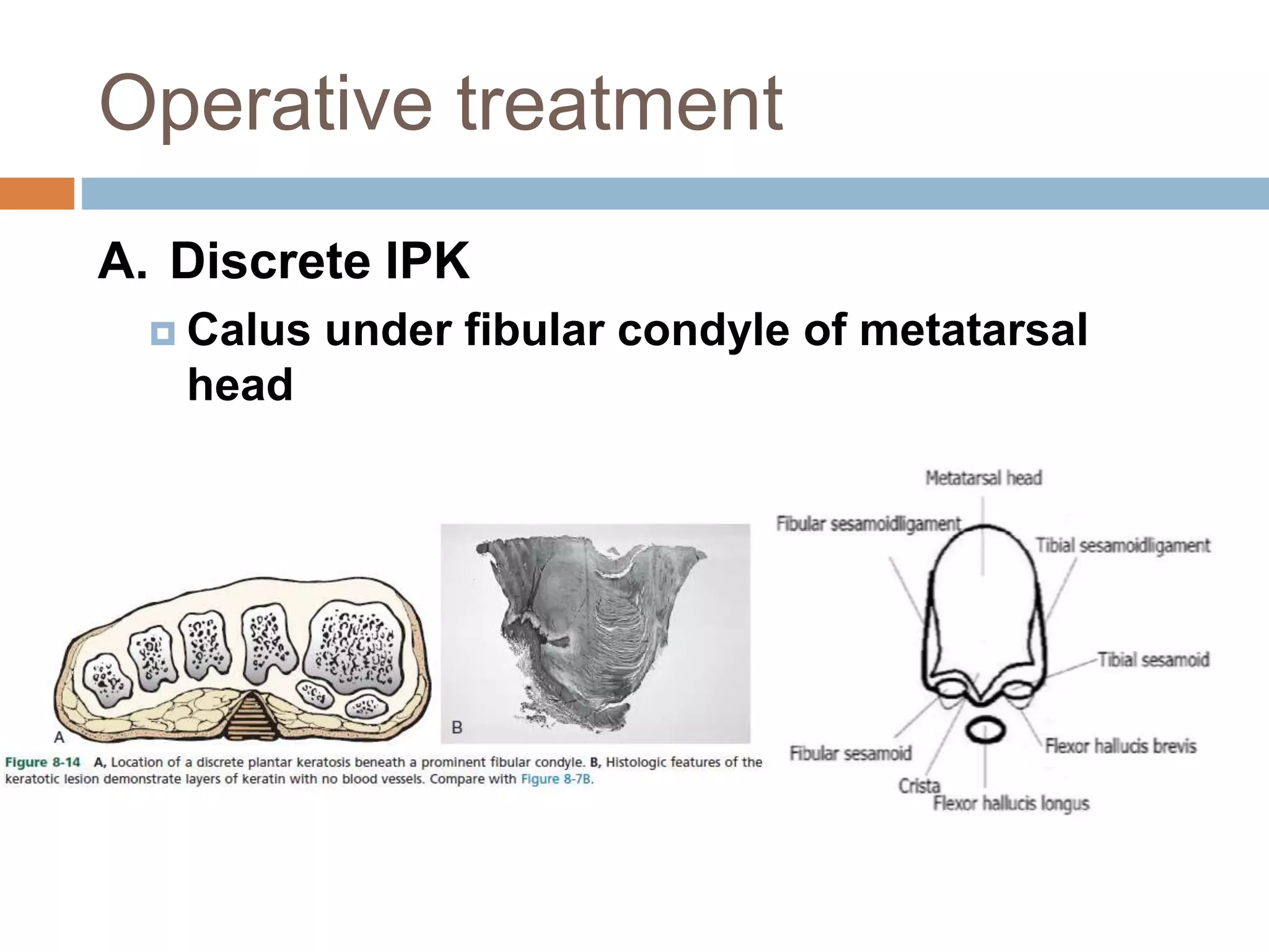 Plantar keratosis | PPT