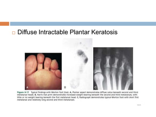 Plantar keratosis | PPTX