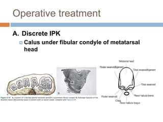 Plantar keratosis | PPTX