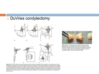 Plantar keratosis | PPTX