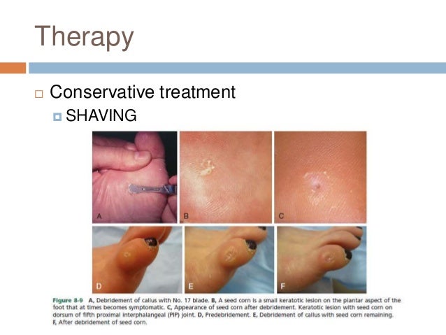 Plantar Keratosis