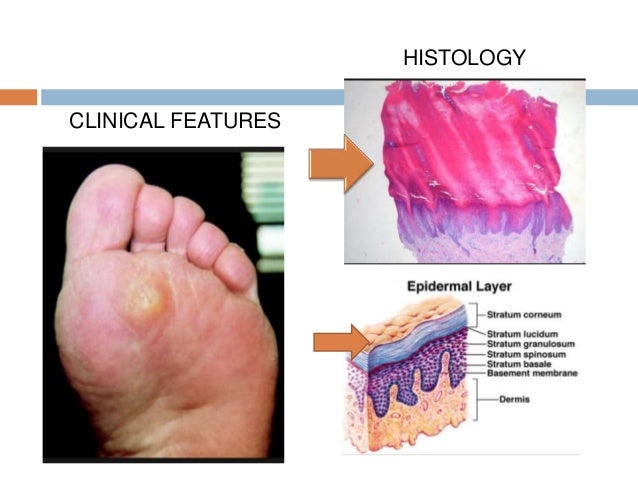 Plantar keratosis