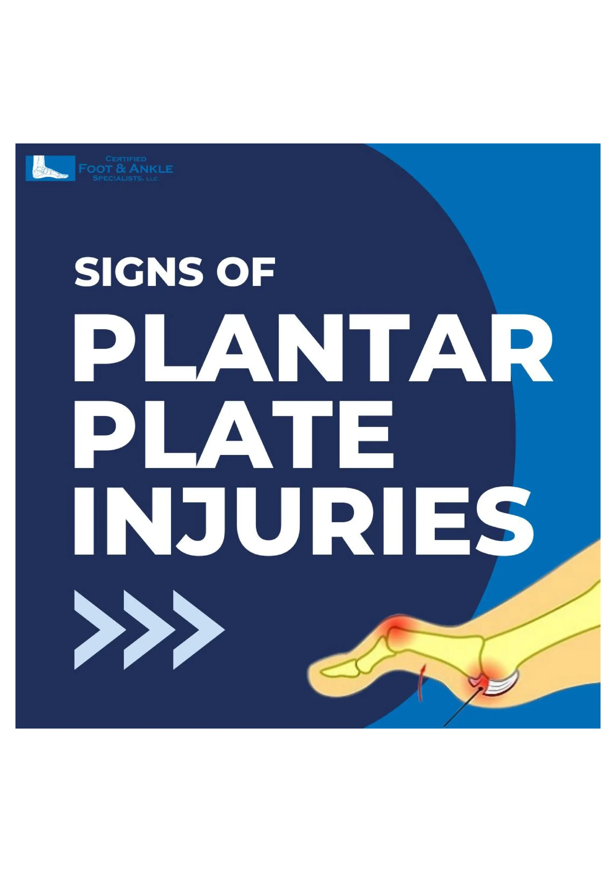 Sign of Plantar Plate Injuries - Certified Foot | PDF