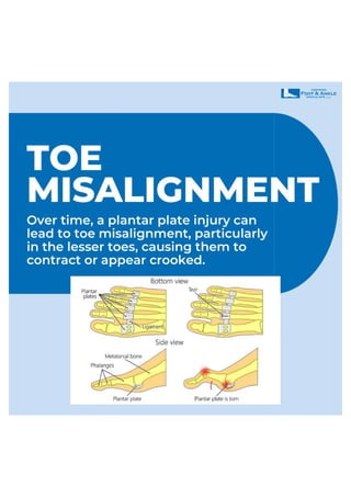 Sign of Plantar Plate Injuries - Certified Foot | PDF