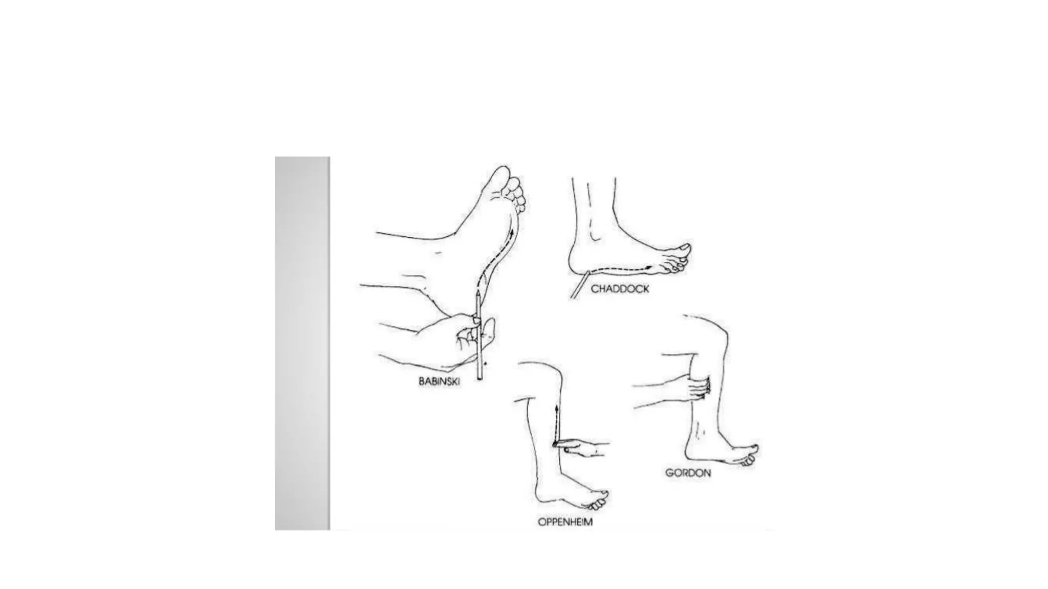 Plantar reflex | PPTX