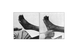 Plantar reflex | PPTX