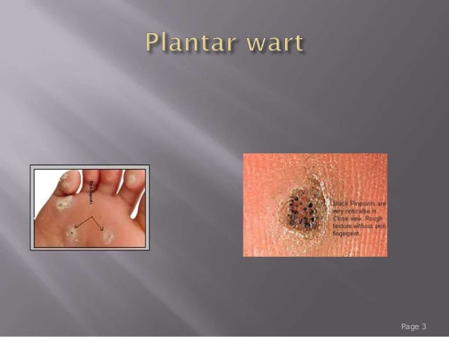 Plantar warts