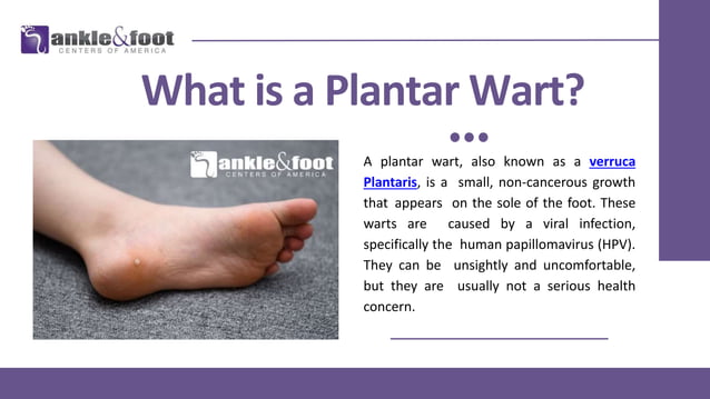Plantar Wart Treatment | PPT