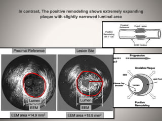 acute coronary syndrome | PPT