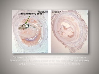 acute coronary syndrome | PPT
