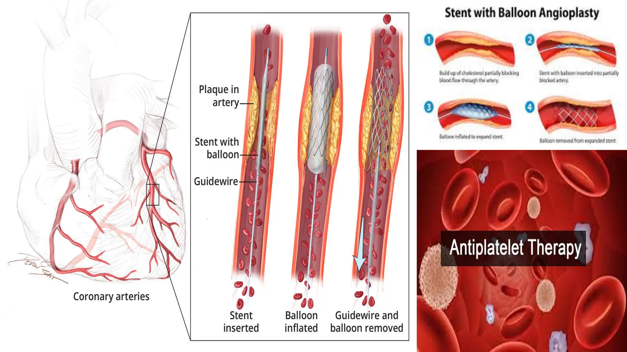 TYPES OF CORONARY PLAQUES SLIDESHARE PRESENTATION | PDF