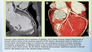 TYPES OF CORONARY PLAQUES SLIDESHARE PRESENTATION | PDF