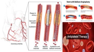 TYPES OF CORONARY PLAQUES SLIDESHARE PRESENTATION | PDF