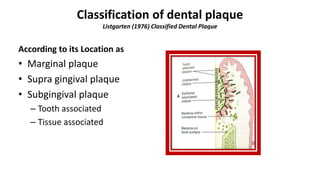 plaque as a biofilm power point in periodontics | PPTX
