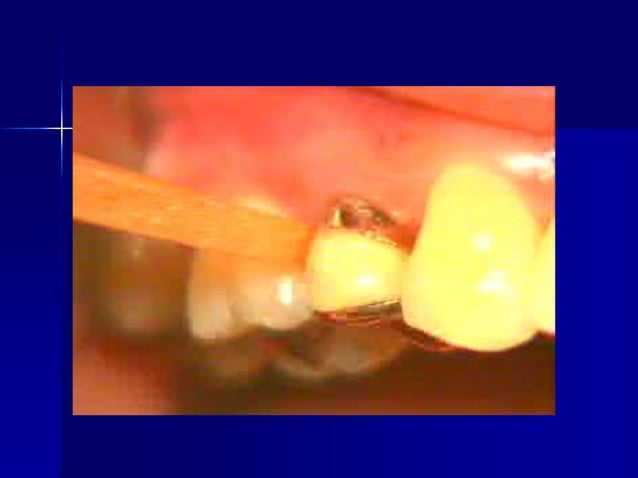 Plaque control | PDF | Oral care | Personal Care