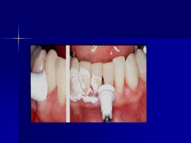 Plaque control | PDF | Oral care | Personal Care