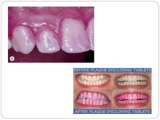 Plaque, Calculus, and Soft Deposits PowerPoint | PPTX | Dental Health ...