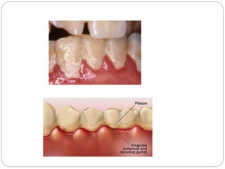 Plaque, Calculus, and Soft Deposits PowerPoint | PPTX