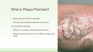 Plaque psoriasis presentation | PPTX