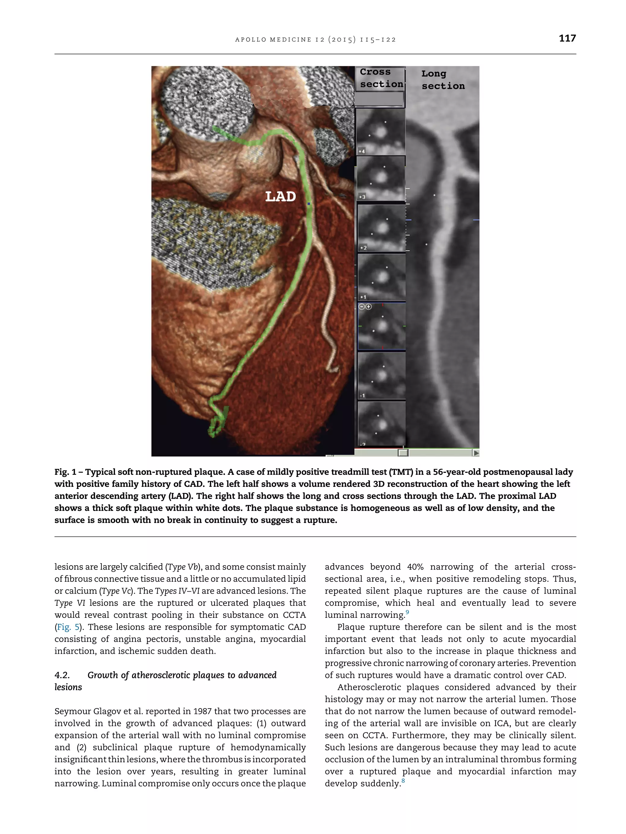 Plaque rupture relationship to plaque composition in coronary arteries ...
