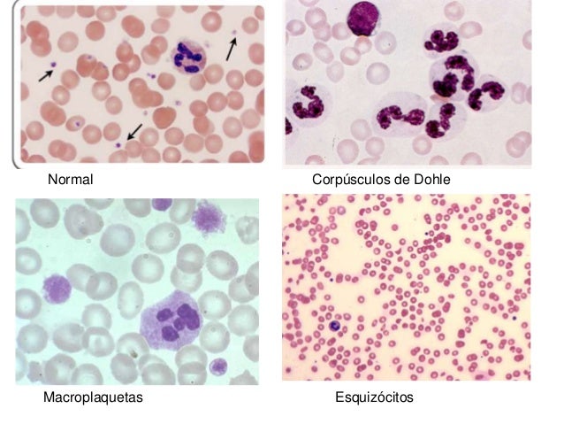 Plaquetas fisiologia e avaliacao laboratorial