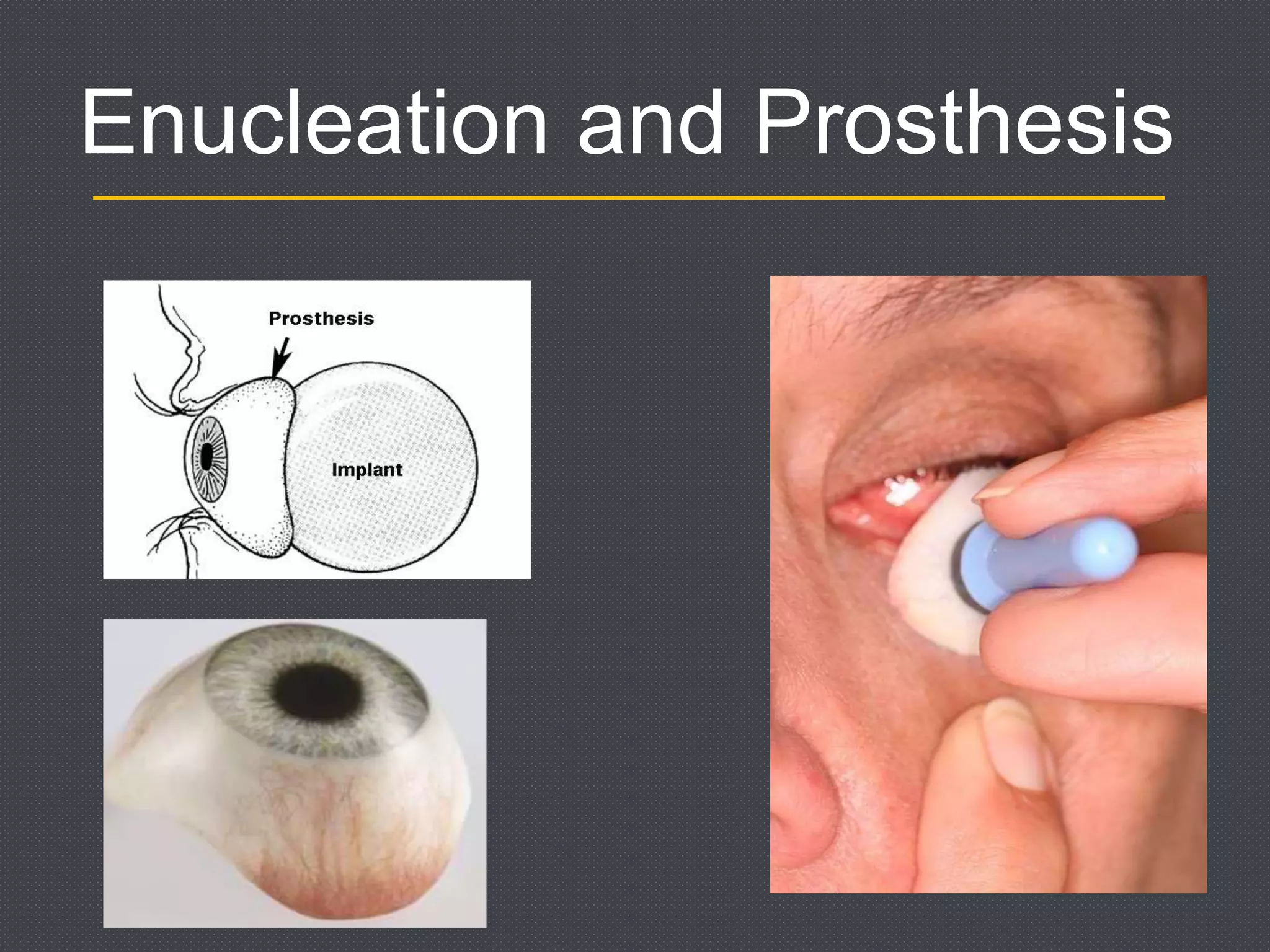 Plaque Radiotherapy for Uveal Melanoma | PPTX