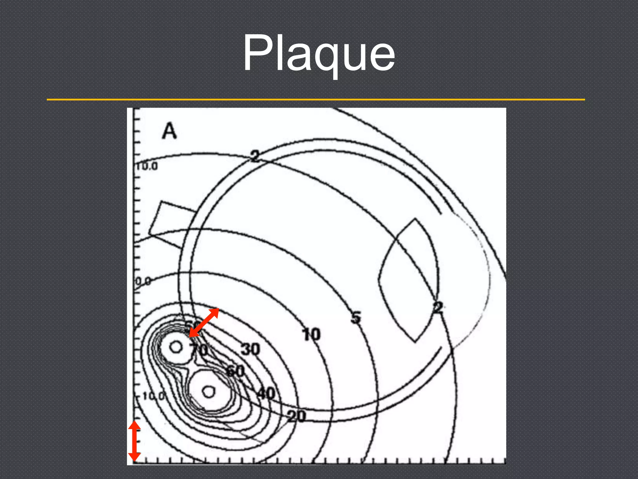 Plaque Radiotherapy for Uveal Melanoma | PPTX