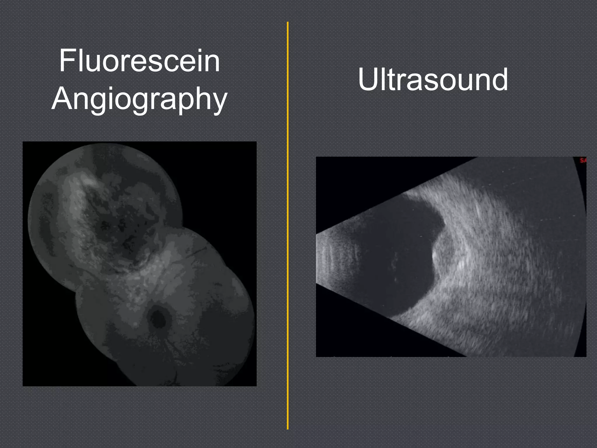 Plaque Radiotherapy for Uveal Melanoma | PPTX